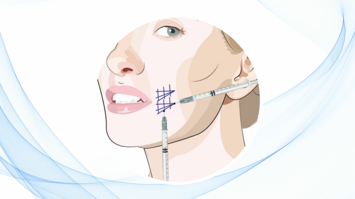 Tratamiento de la Hipertrofia de Maseteros con Toxina Botulínica