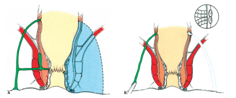 Fístula anorrectal: Diferencias entre fistulotomía y fistulectomía
