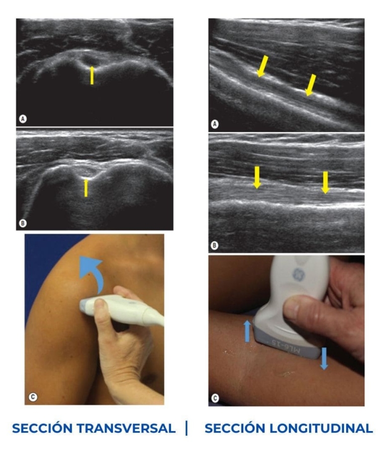 Artefactos en Ecografía Musculoesquelética