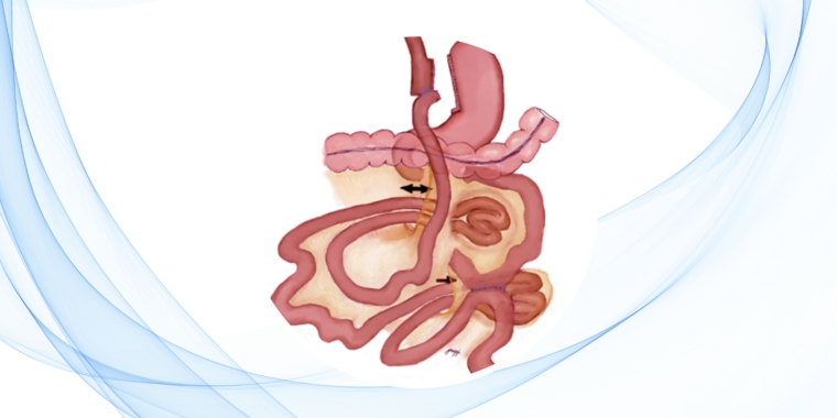 Obstrucciones intestinales tras un bypass gástrico laparoscópico