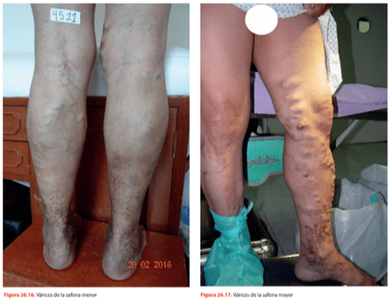 Escleroterapia para várices con tratamiento ecoguiado