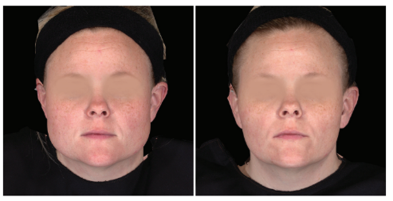 Tratamiento de la Hipertrofia de Maseteros con Toxina Botulínica