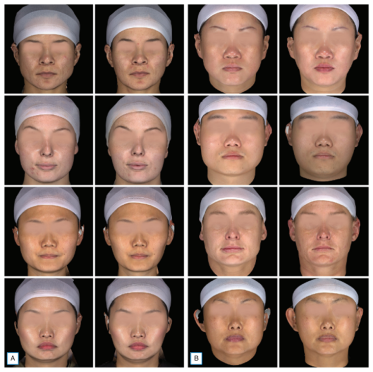 Tratamiento de la Hipertrofia de Maseteros con Toxina Botulínica