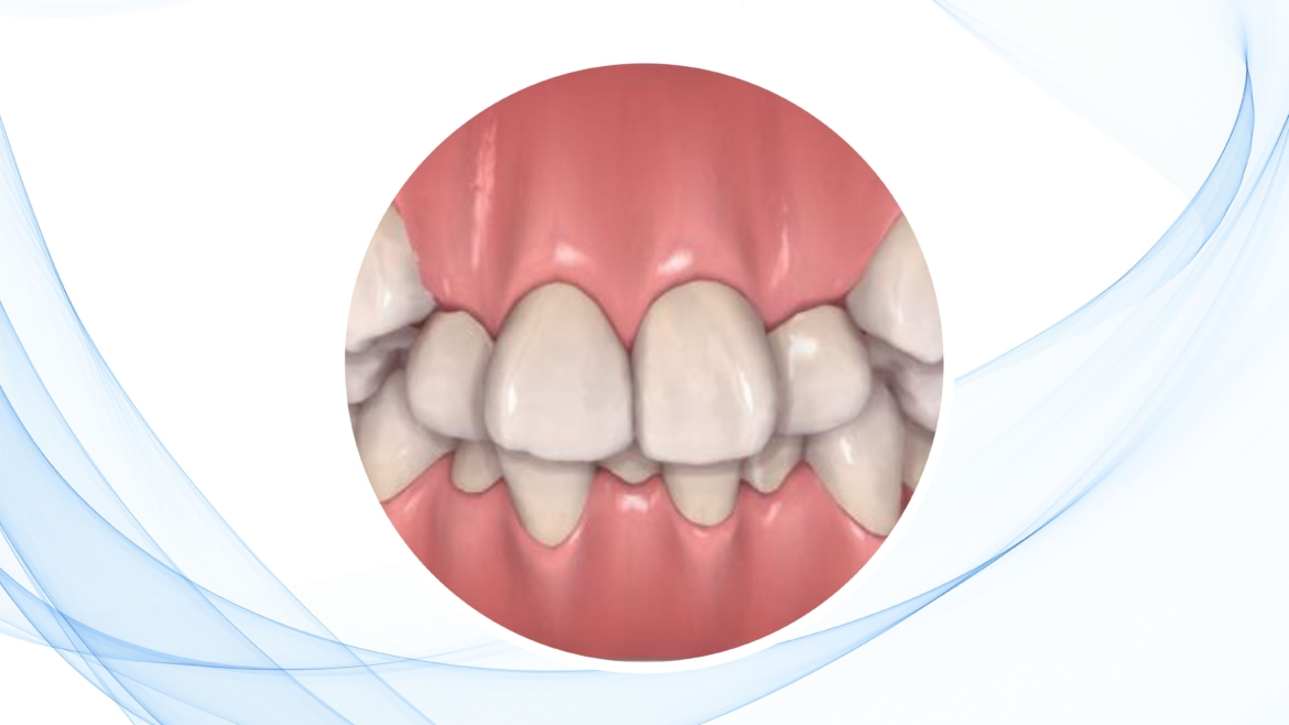 Condilografía: analizando la dirección del cóndilo mandibular como guía ...