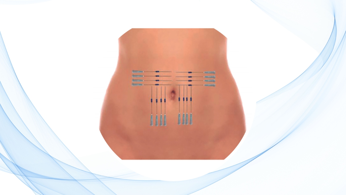 Tratamiento de la Hipertrofia de Maseteros con Toxina Botulínica