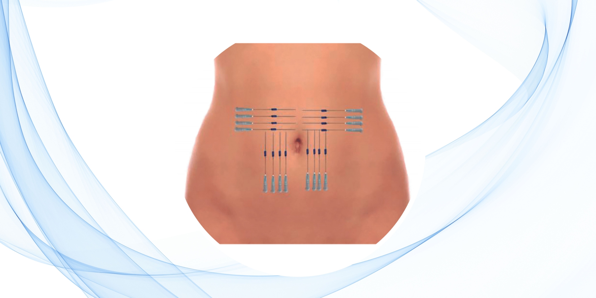 Tratamientos Corporales con Hilos PDO: Lo que Necesitas Saber