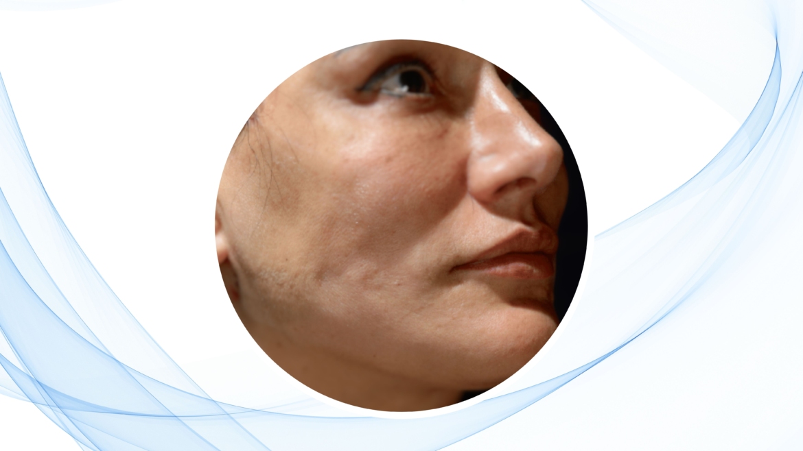 Tratamiento de la Hipertrofia de Maseteros con Toxina Botulínica