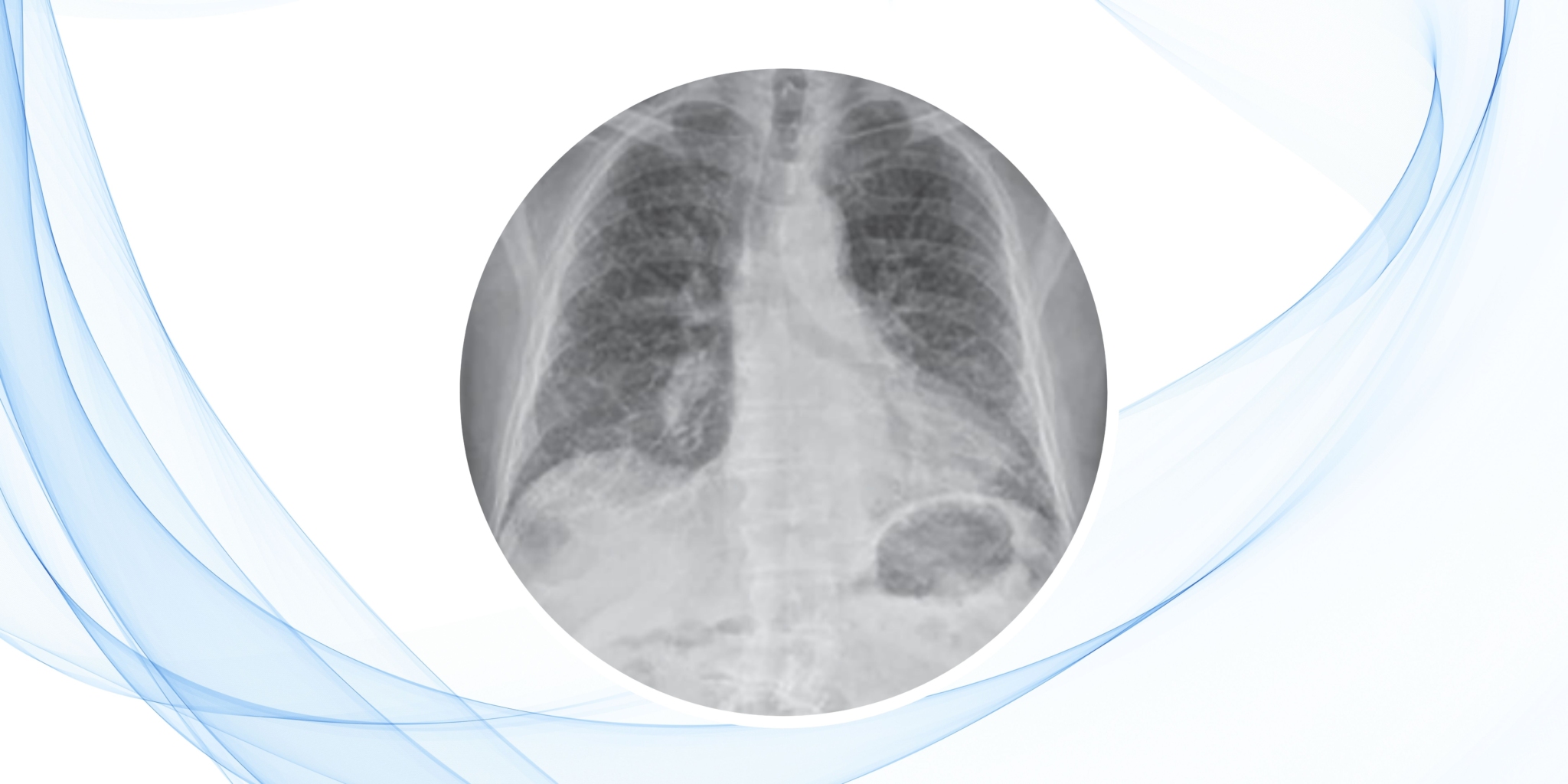 Fibrosis pulmonar idiopática: diagnóstico y manejo - Amolca